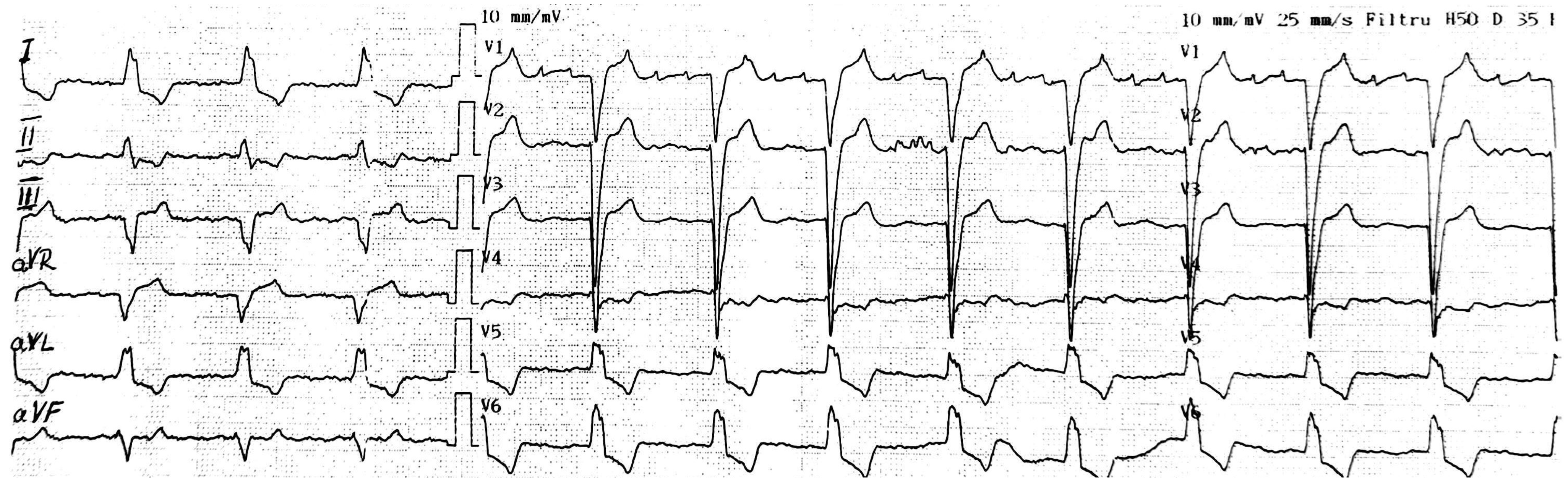 Drug-Induced Complete Atrioventricular Block in an Elderly Patient: A ...