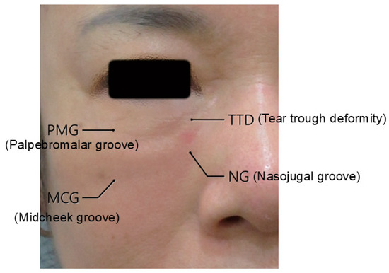 Anatomical-Based Filler Injection Diagnosis to Treatment Techniques ...