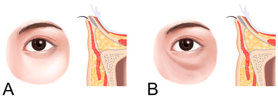 Anatomical-Based Filler Injection Diagnosis to Treatment Techniques ...