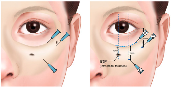 Anatomical-Based Filler Injection Diagnosis to Treatment Techniques ...