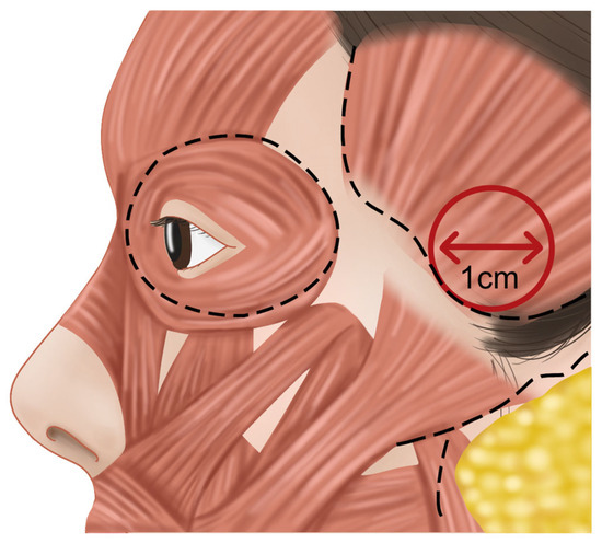 An Expert Guide to Anatomy-Based Filler Injection for the Temple ...