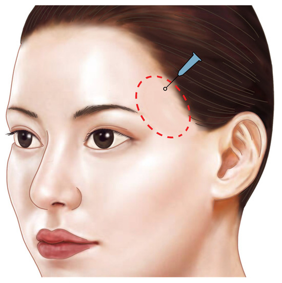 An Expert Guide to Anatomy-Based Filler Injection for the Temple ...