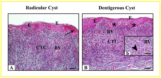 Expression of Dlx-5 and HLX Proteins in Odontogenic Cysts