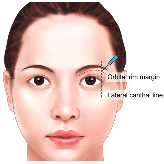 Anatomy-Based Filler Injection: Treatment Techniques for Supraorbital ...