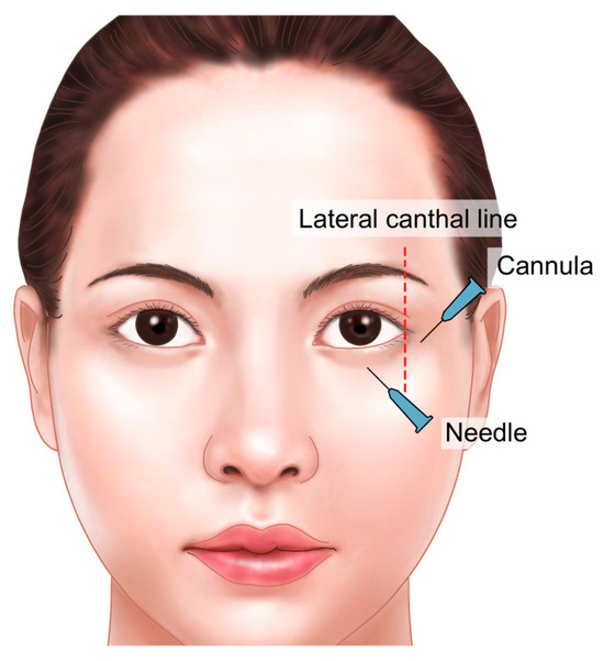 Anatomy-Based Filler Injection: Treatment Techniques for Supraorbital ...