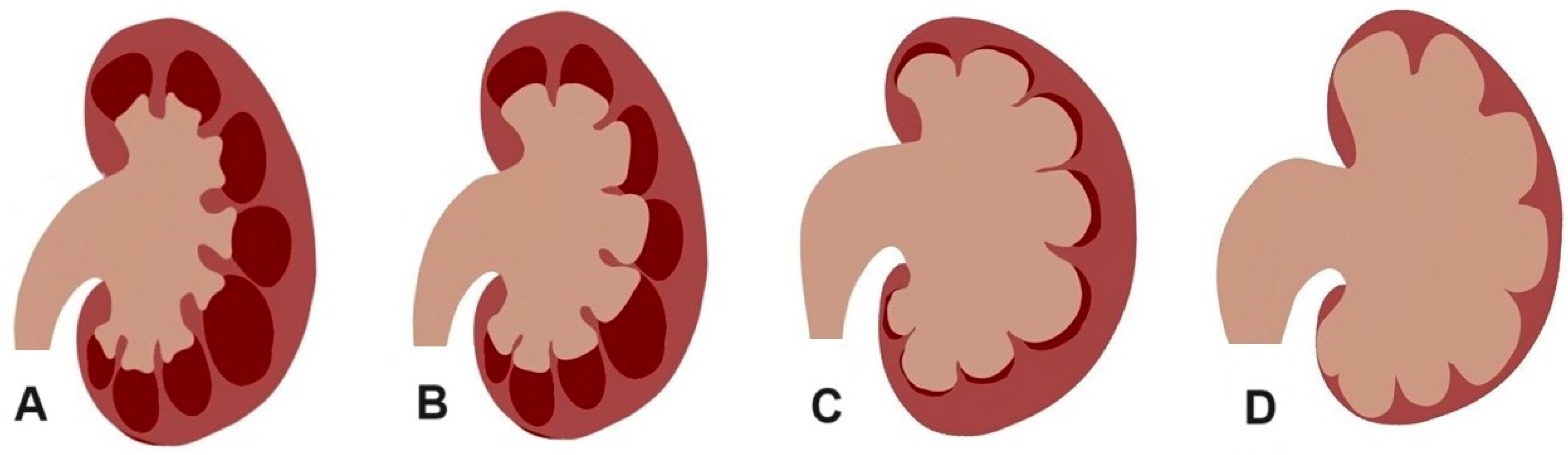 Association Between Nephrolith Size and Location and Grade of Hydronephrosis