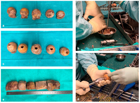 Introducing the Pearl-String Technique: A New Concept in the Treatment ...