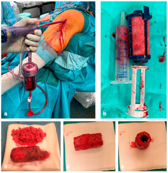 Introducing the Pearl-String Technique: A New Concept in the Treatment ...