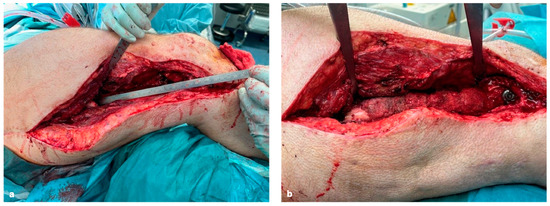 Introducing the Pearl-String Technique: A New Concept in the Treatment ...