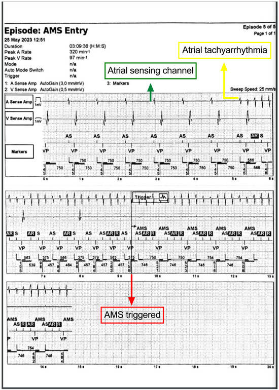 New-Onset Atrial Fibrillation in Patients with Pacemakers and the ...