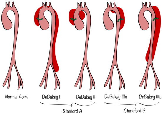 Outcomes of Surgical Versus Conservative Management in Stanford Type a ...
