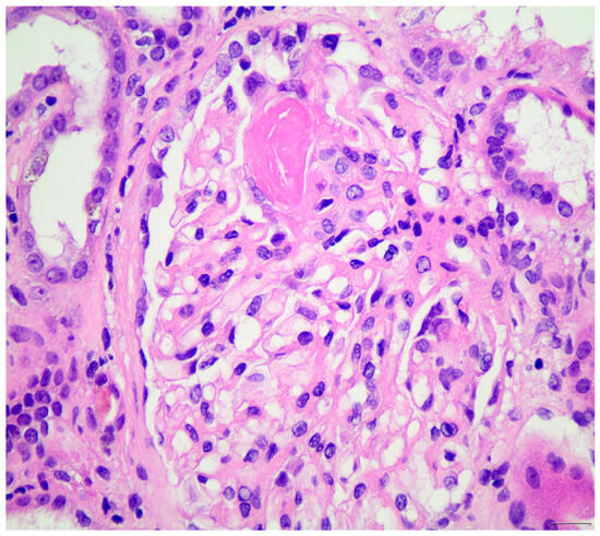 Current Understanding of the Pathogenesis of ANCA-Associated Vasculitis ...
