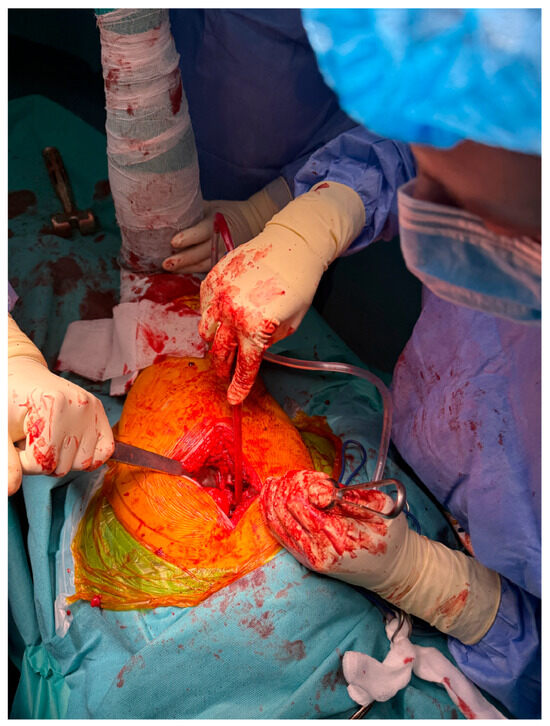 Stepwise Total Hip Arthroplasty with Lateral and Posterolateral ...