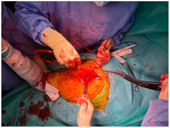 Stepwise Total Hip Arthroplasty with Lateral and Posterolateral ...