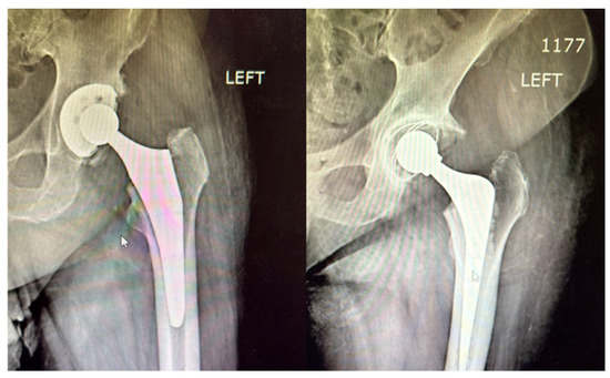 Stepwise Total Hip Arthroplasty with Lateral and Posterolateral ...