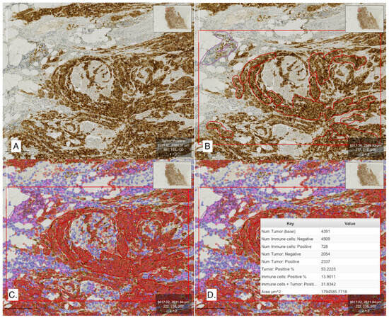Artificial Intelligence (AI) for Programmed Death Ligand-1 (PD-L1) Immunohistochemical ...