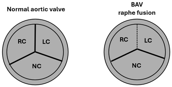 Bicuspid Aortic Valve and Sudden Cardiac Death