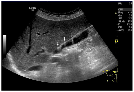 Ultrasound of the Gallbladder—An Update on Measurements, Reference ...