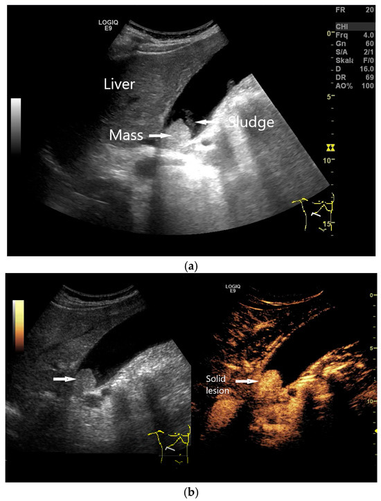 Ultrasound of the Gallbladder—An Update on Measurements, Reference ...
