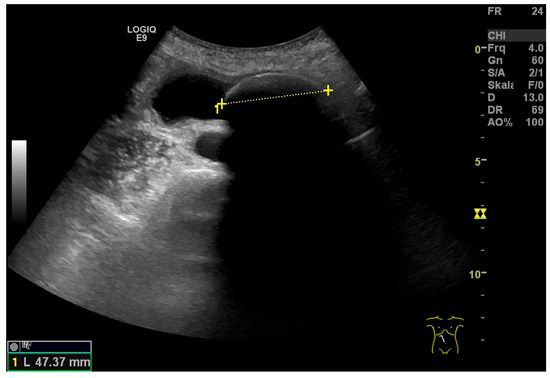 Ultrasound of the Gallbladder—An Update on Measurements, Reference ...