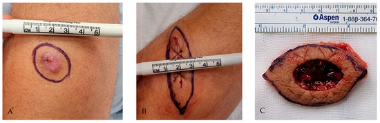 Overcoming Mohs Limitations in Treating DFSP: Retrospective Analysis of ...