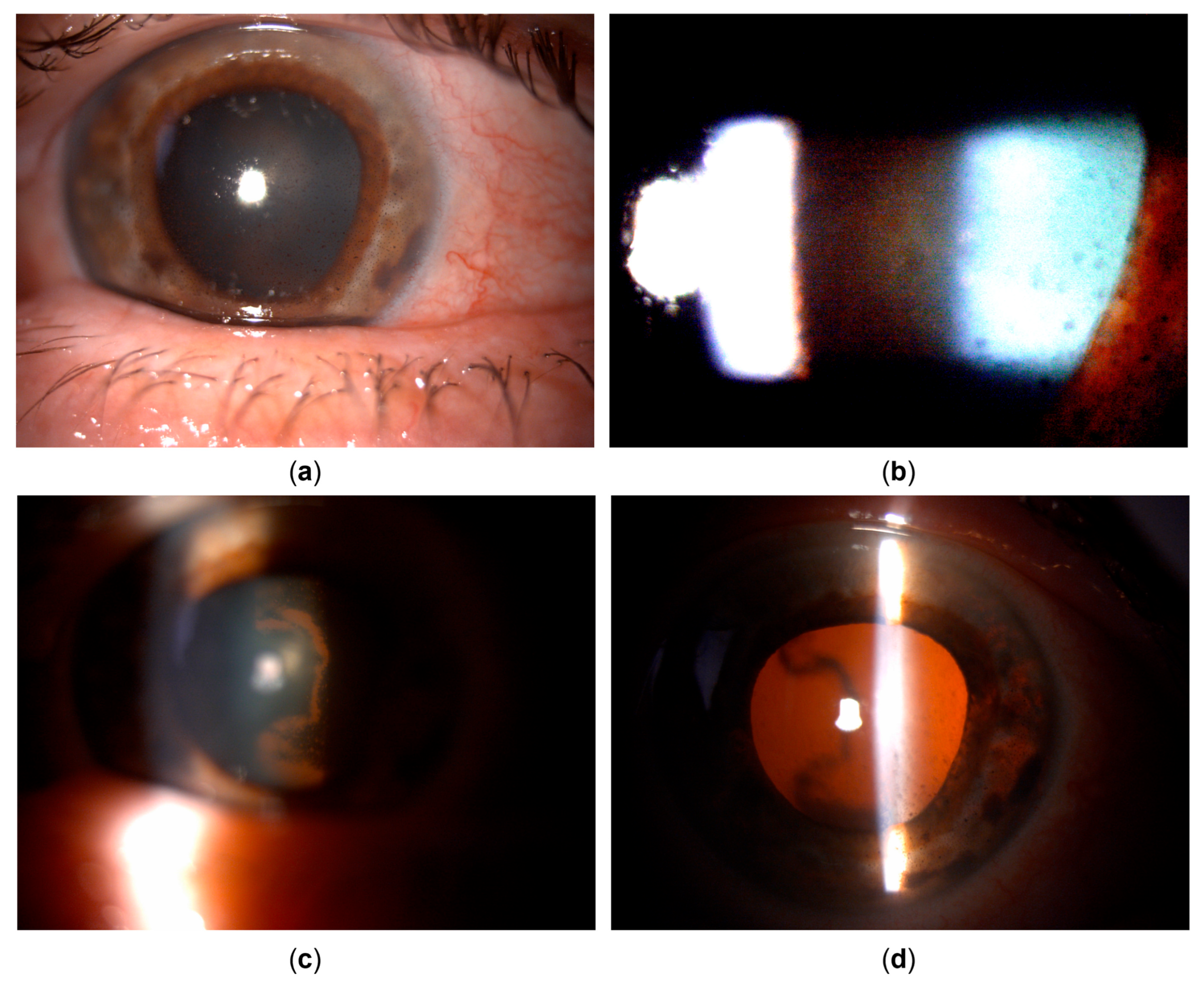 An Unusual Manifestation of HSV-1 Uveitis Transforming into an Acute Iris Transillumination-like ...