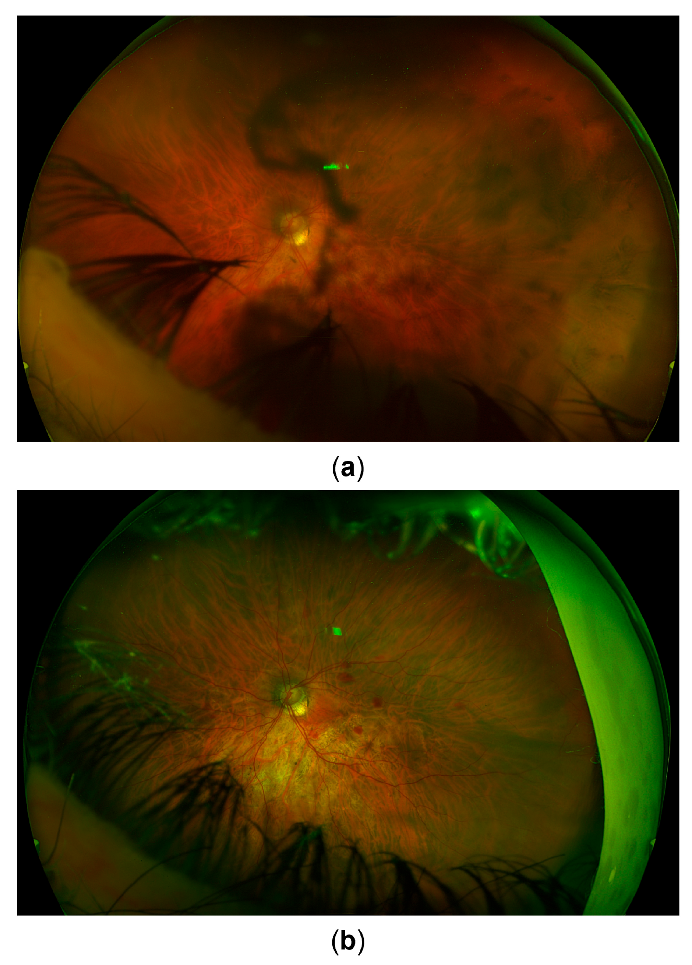 An Unusual Manifestation of HSV-1 Uveitis Transforming into an Acute ...