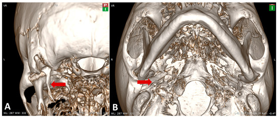 An Abnormally Long Styloid Process Without Stylohyoid Ligament ...