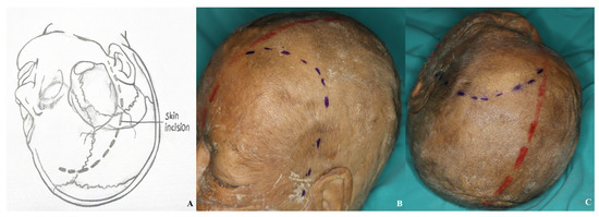 Exploring the Lamina Terminalis: A Stepwise Anatomical Comparison of ...