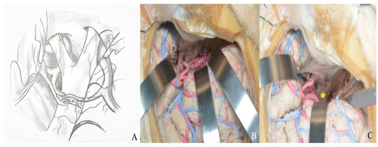 Exploring the Lamina Terminalis: A Stepwise Anatomical Comparison of ...