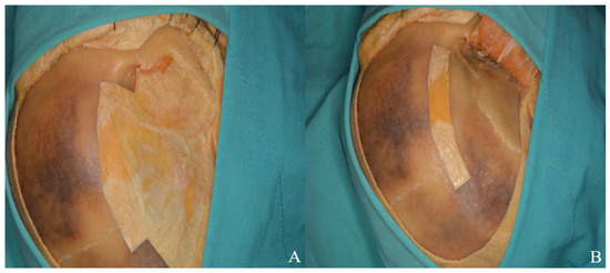 Exploring the Lamina Terminalis: A Stepwise Anatomical Comparison of ...