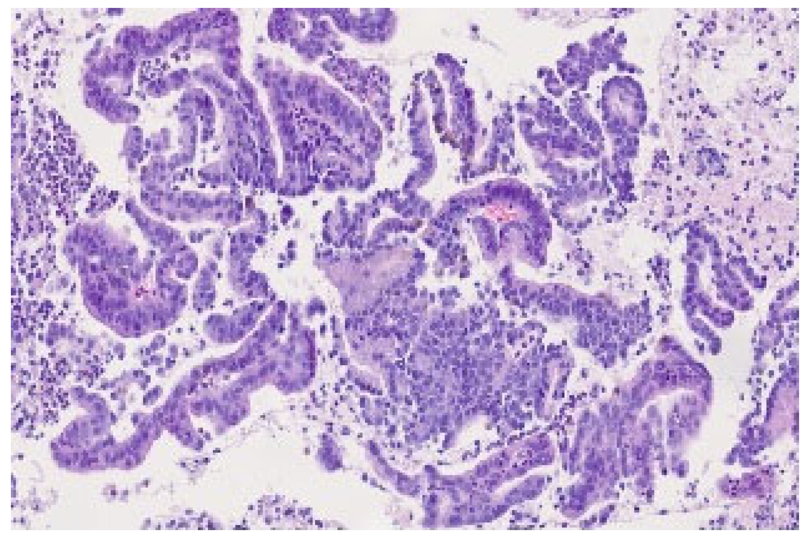 Ductal Adenocarcinoma Pancreas Mypathologyreportca