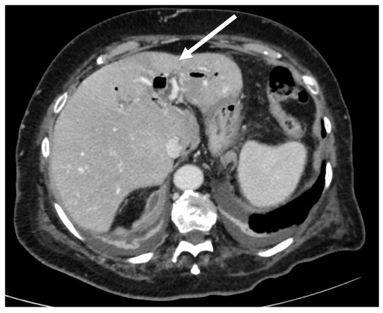 Lobar and Segmental Atrophy of the Liver: Differential Diagnoses and ...