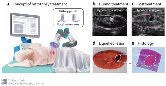 Abscopal Effect with Liver-Directed Therapy: A Review of the Current ...