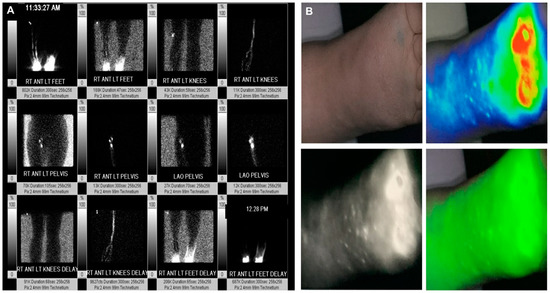 Lymphoscintigraphy versus Indocyanine Green Lymphography—Which Should ...