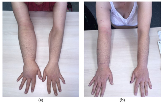 The Lymphatic System—A Surgeon’s Point of View