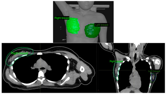 Motion Management: The Road Map to Accurate Radiation Treatment Delivery