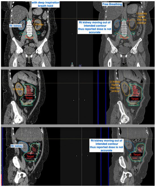 Motion Management: The Road Map to Accurate Radiation Treatment Delivery