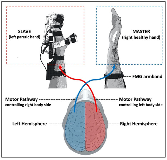 Design of a 3D-Printed Hand Exoskeleton Based on Force-Myography ...