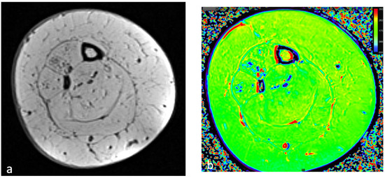 MRI Quantitative Evaluation of Muscle Fatty Infiltration