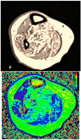 MRI Quantitative Evaluation of Muscle Fatty Infiltration