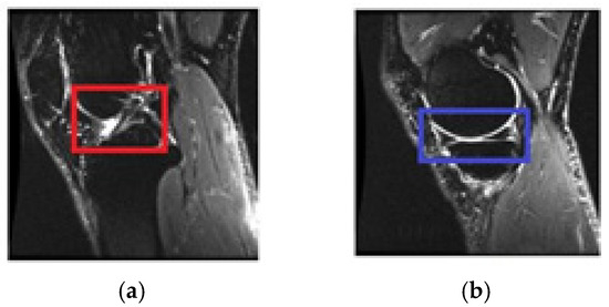 Detection and Classification of Knee Injuries from MR Images Using the ...