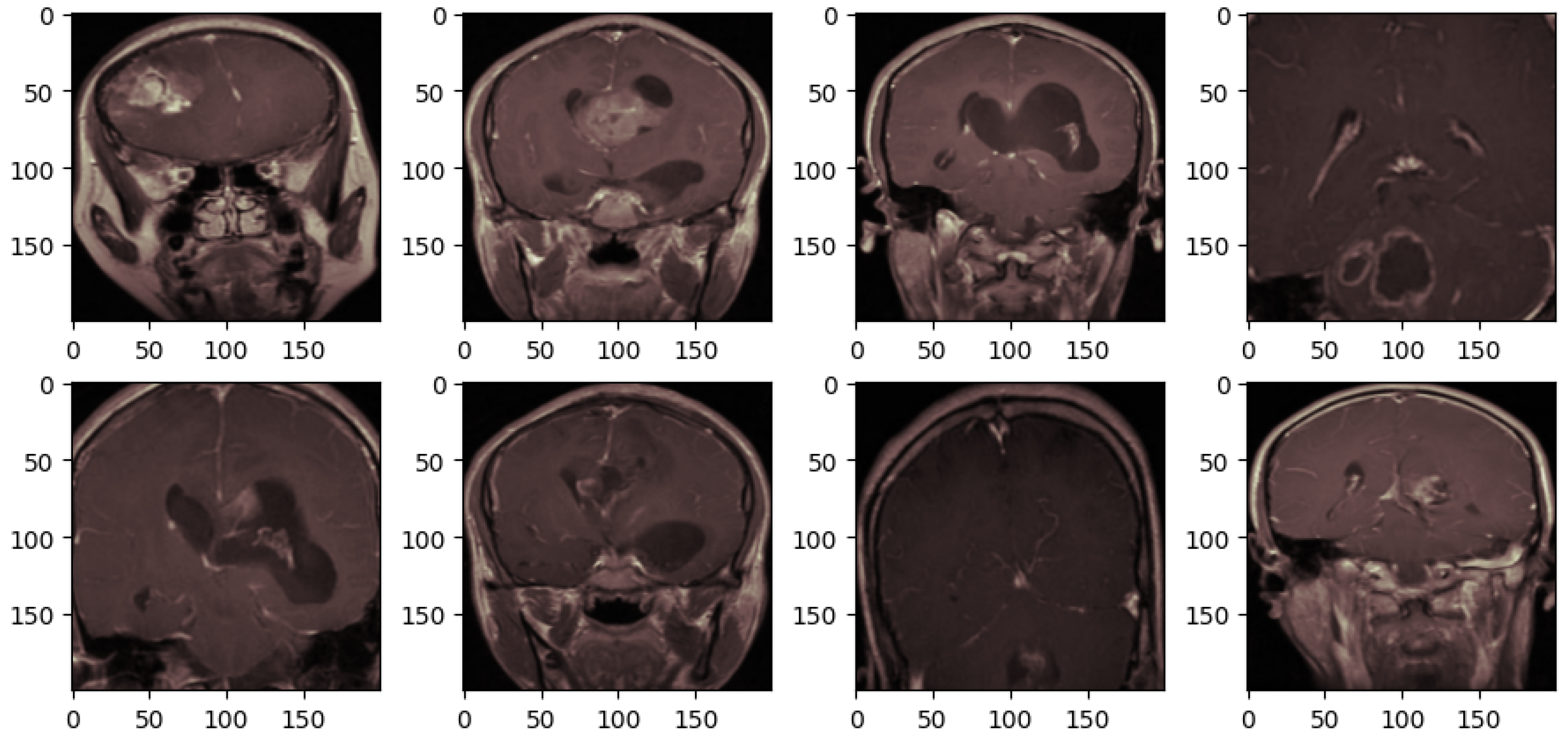 Empowering Brain Tumor Diagnosis through Explainable Deep Learning