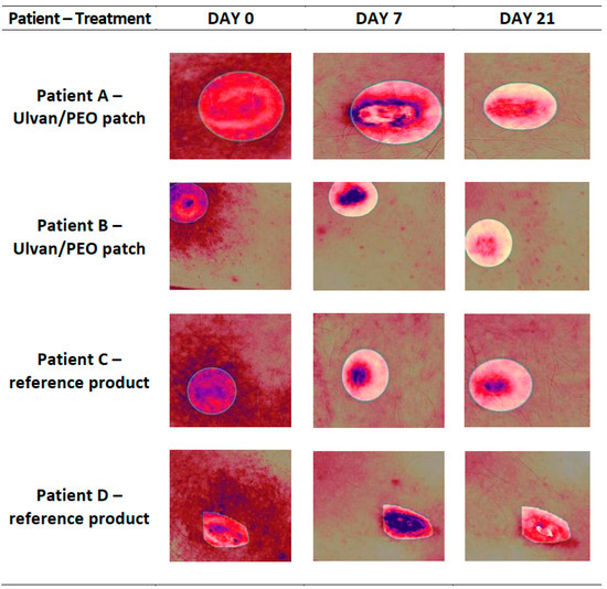 Ulvan-Based Nanofibrous Patches Enhance Wound Healing of Skin Trauma ...