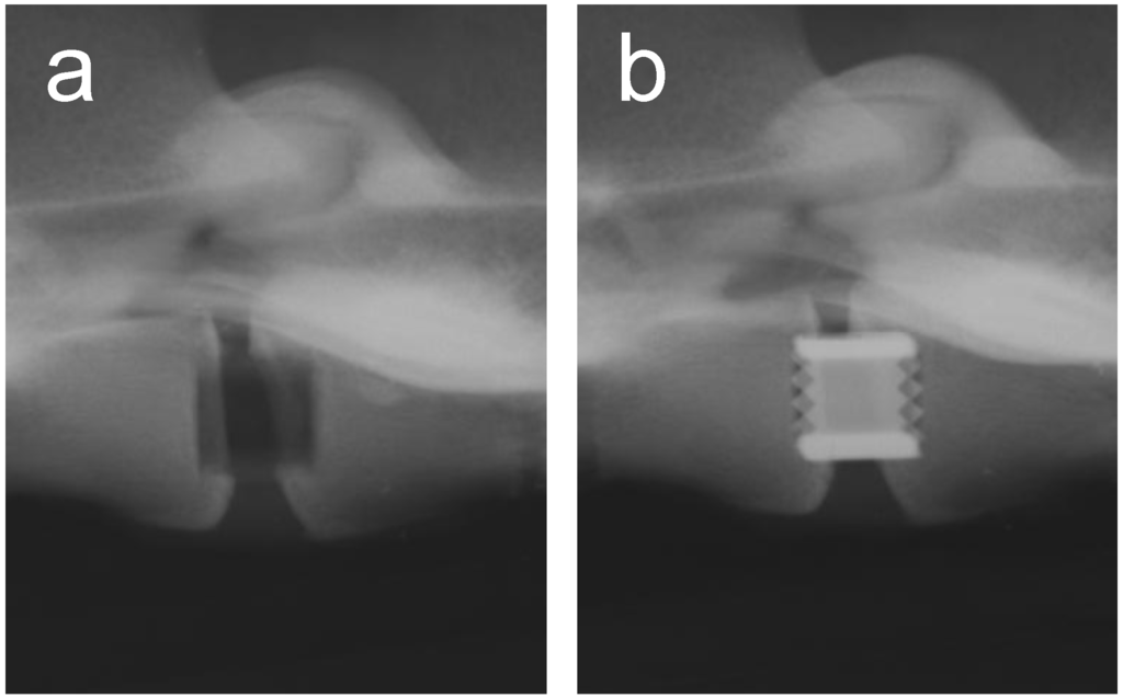 Biodegradable Polymers in Bone Tissue Engineering