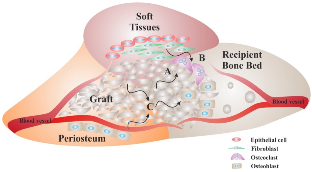 Bone Replacement Materials and Techniques Used for Achieving Vertical ...