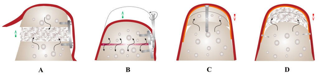 Bone Replacement Materials and Techniques Used for Achieving Vertical ...