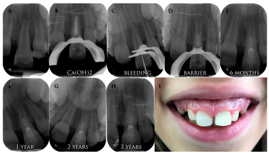 Regenerative Endodontic Procedures Using Contemporary Endodontic Materials