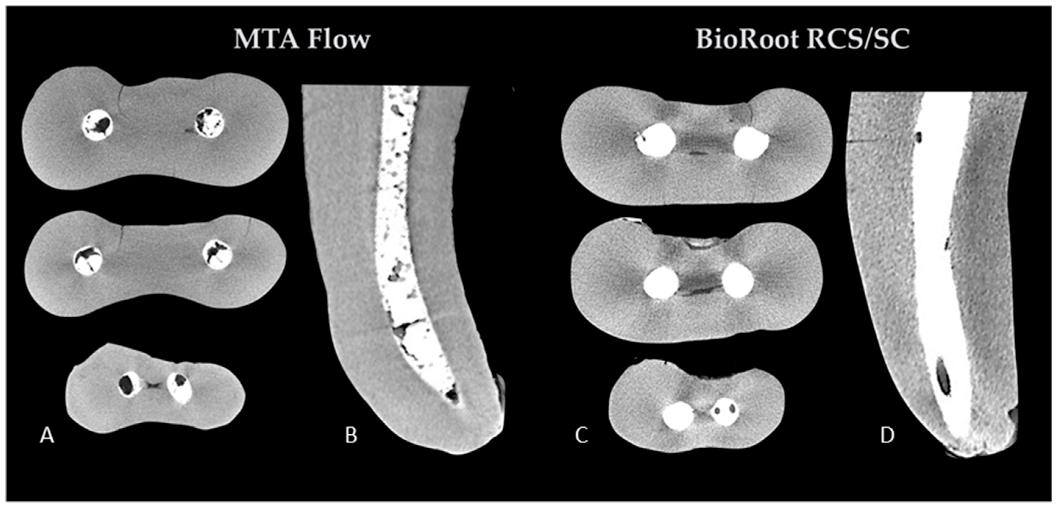 Porosity Distribution in Apically Perforated Curved Root Canals Filled ...