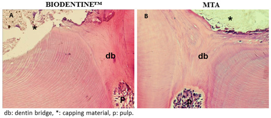 Reparative Mineralized Tissue Characterization after Direct Pulp ...